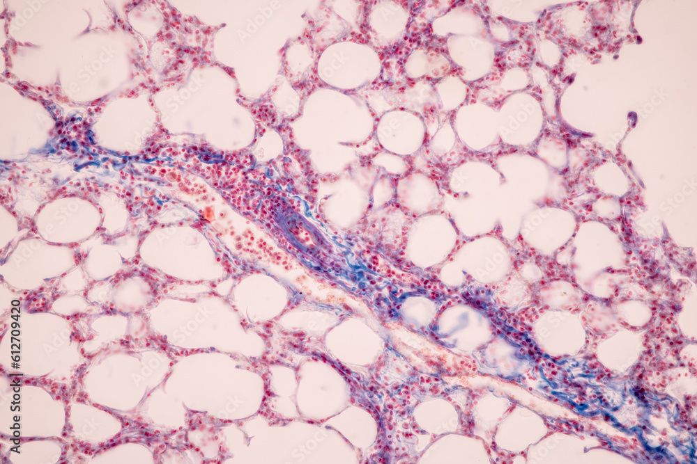 Human lung pathology under light microscope, The lungs is organs of the ...