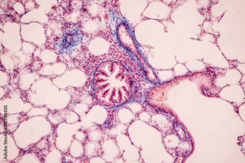 Human lung pathology under light microscope, The lungs is organs of the ...