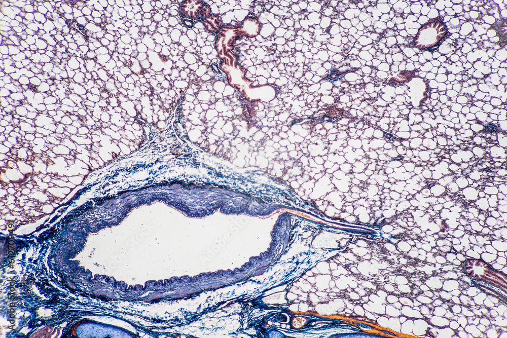 Human lung pathology under light microscope, The lungs is organs of the ...