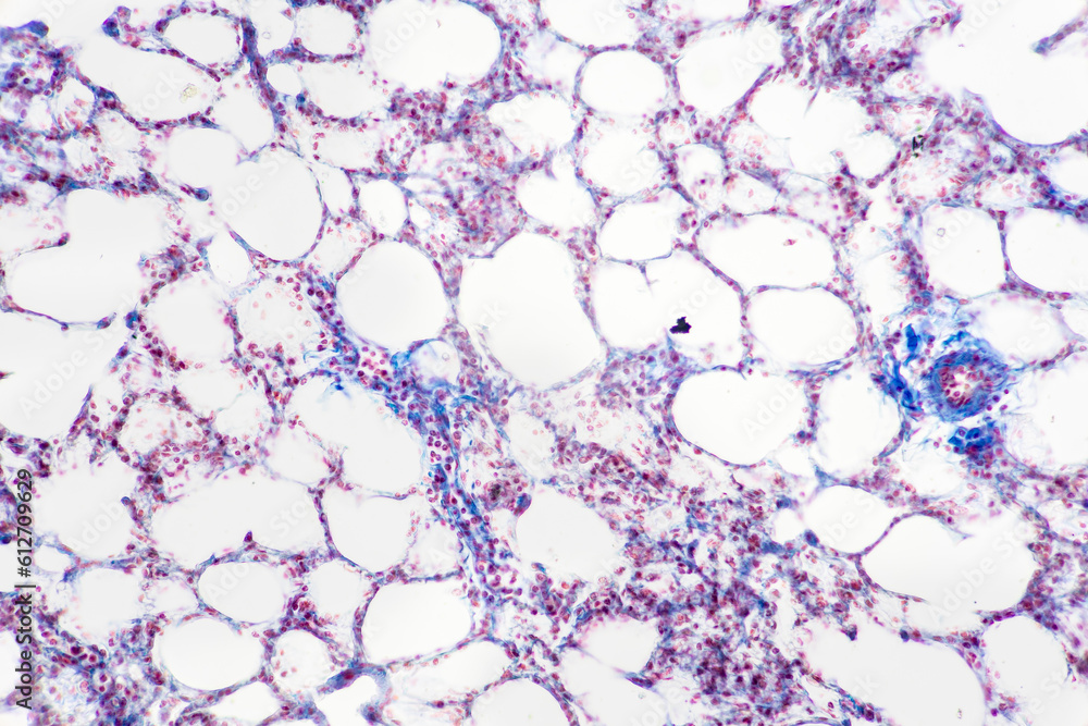 Human lung pathology under light microscope, The lungs is organs of the ...