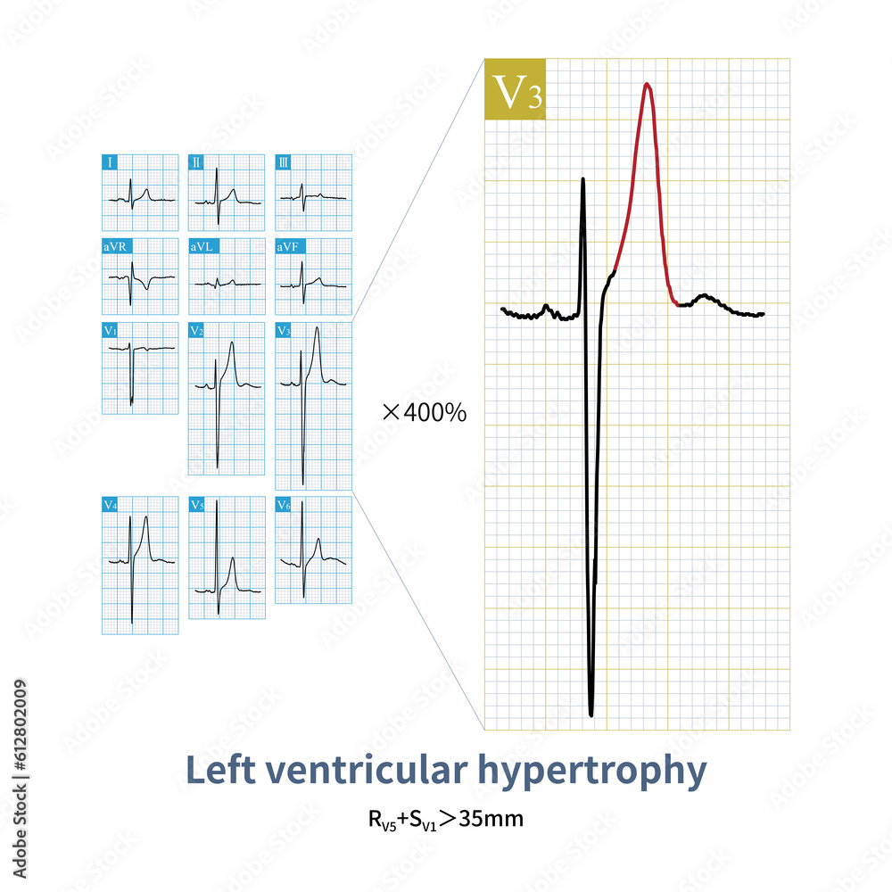 When the left ventricular volume load increases, the ECG not only shows ...