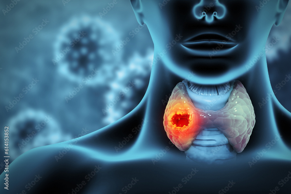 Thyroid gland cancer. showing thyroid gland with tumor. 3d illustration ...
