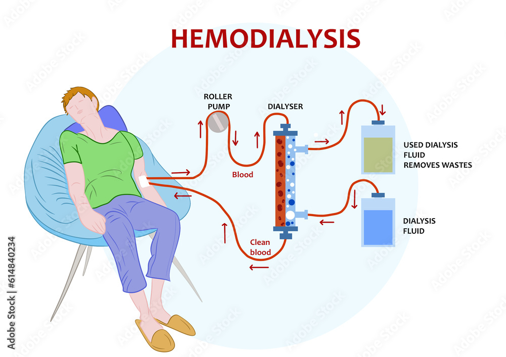 Infographic of hemodialysis, a procedure where a dialysis machine are ...