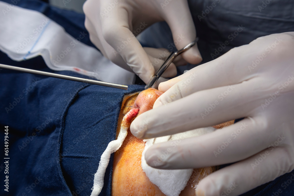 A cosmetic surgeon cuts the columella tissue of the nose with a ...