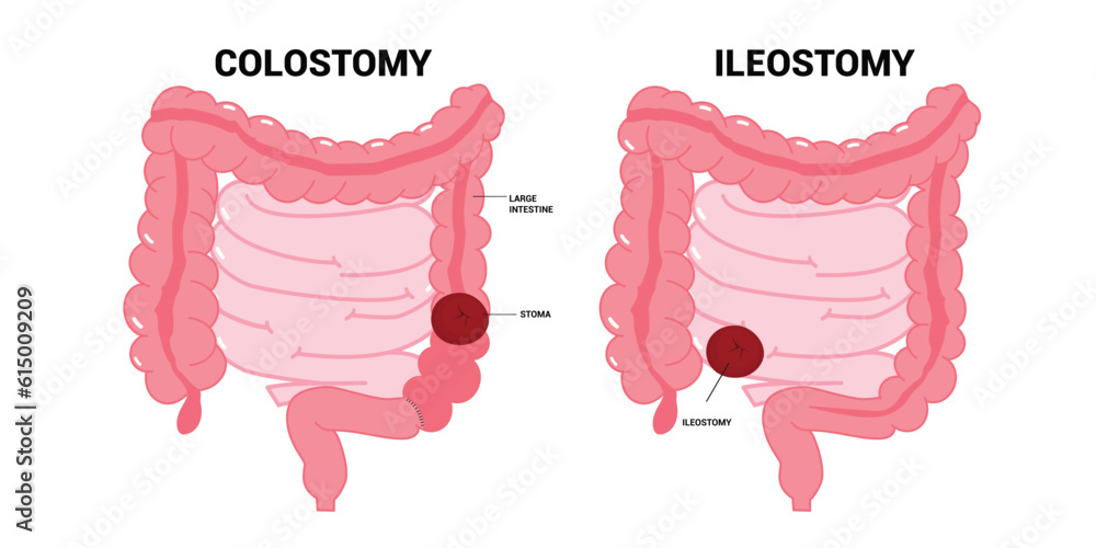 The ileum stoma abdomen Pouch for blocked poo stool system of Small ...