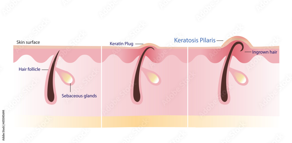 The process of Keratosis Pilaris vector illustration isolated on white ...