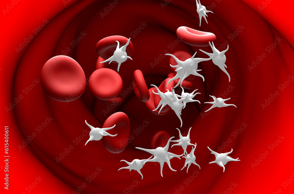 Essential thrombocythemia (ET), overproduction of platelets ...