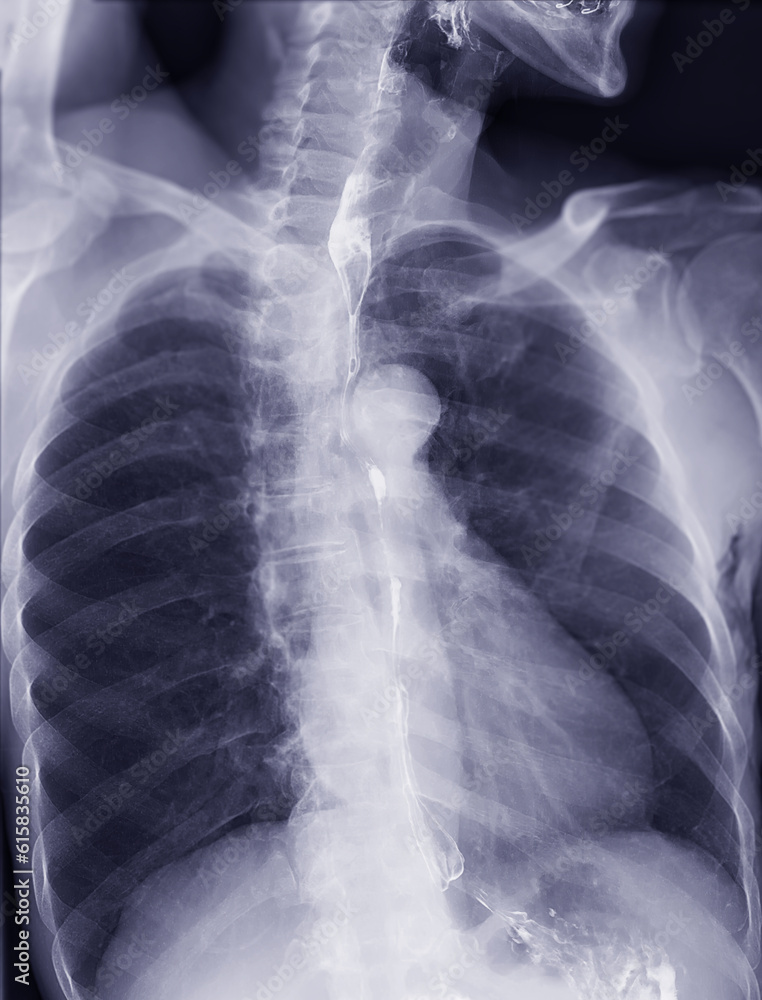 Barium Swallow study test diagnose Barrett's GI tract exam GERD ulcers ...