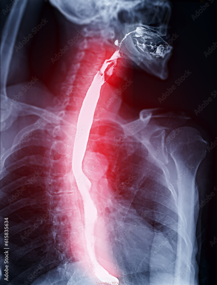 Barium Swallow study test diagnose Barrett's GI tract exam GERD ulcers ...
