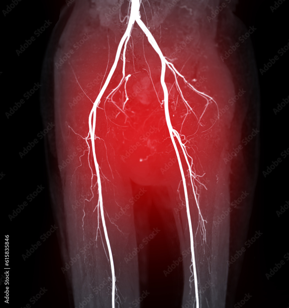 CTA femoral artery run off image of femoral artery for diagnostic Acute ...