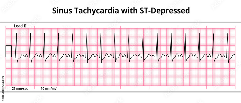 Sinus Tachycardia with ST-Segment Depressed - 8 Second ECG Paper ...
