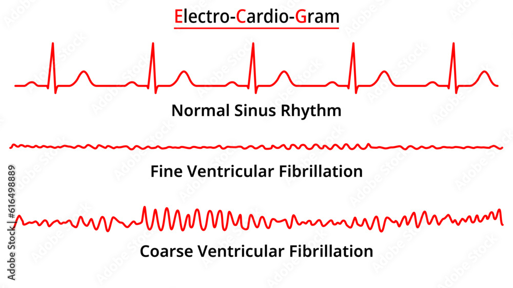 Set of ECG Common Abnormalities - Fine vs Coarse Ventricular Fibrillation (VF) - Normal Sinus ...