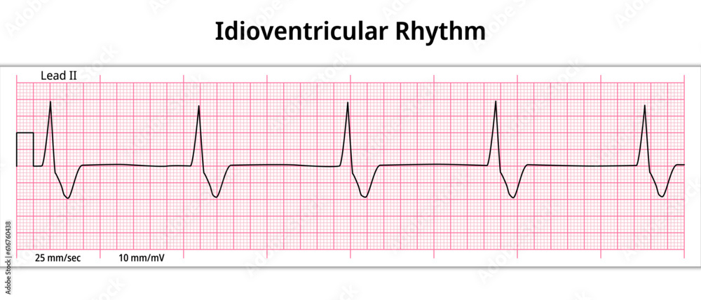ECG Idioventricular Rhythm - 8 Second ECG Paper - Electrocardiography Medical Vector ...