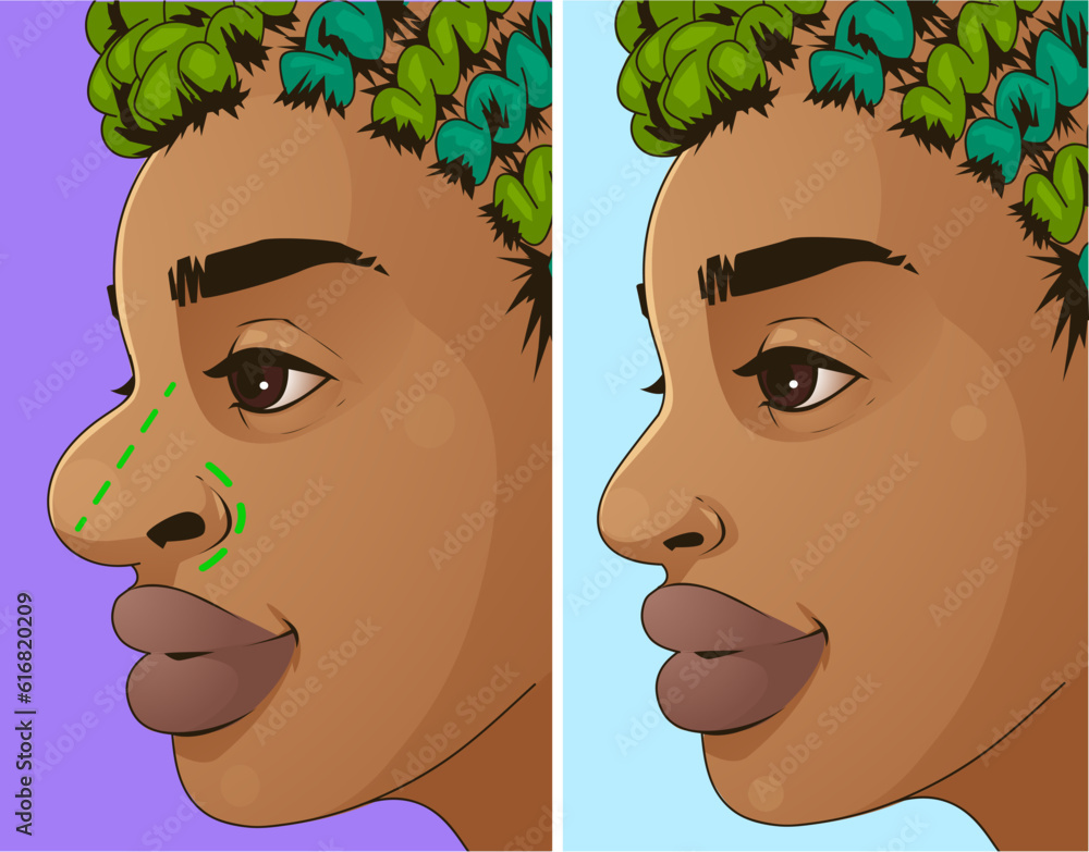 Rhinoplasty, before and after. Correction the shape of the human's nose ...