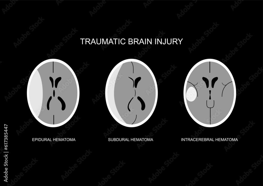 เวกเตอร์ Stock Illustration of common CT imaging following traumatic ...