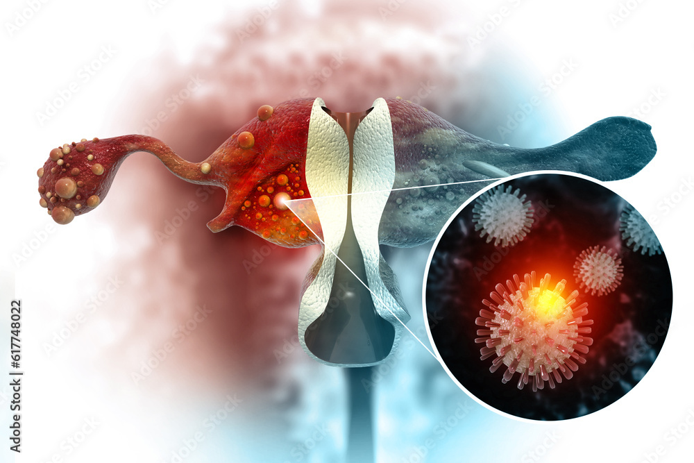 Ilustración de Stock Female reproductive system diseases. Uterus cancer ...
