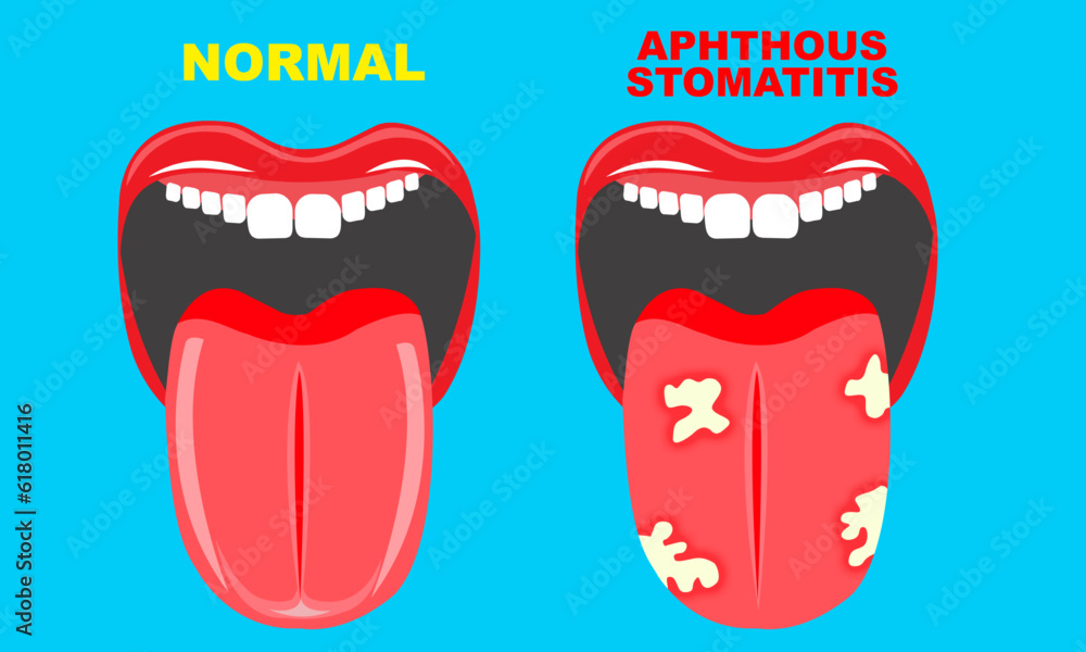 illustration of mouth and tongue problems with aphthous stomatitis ...