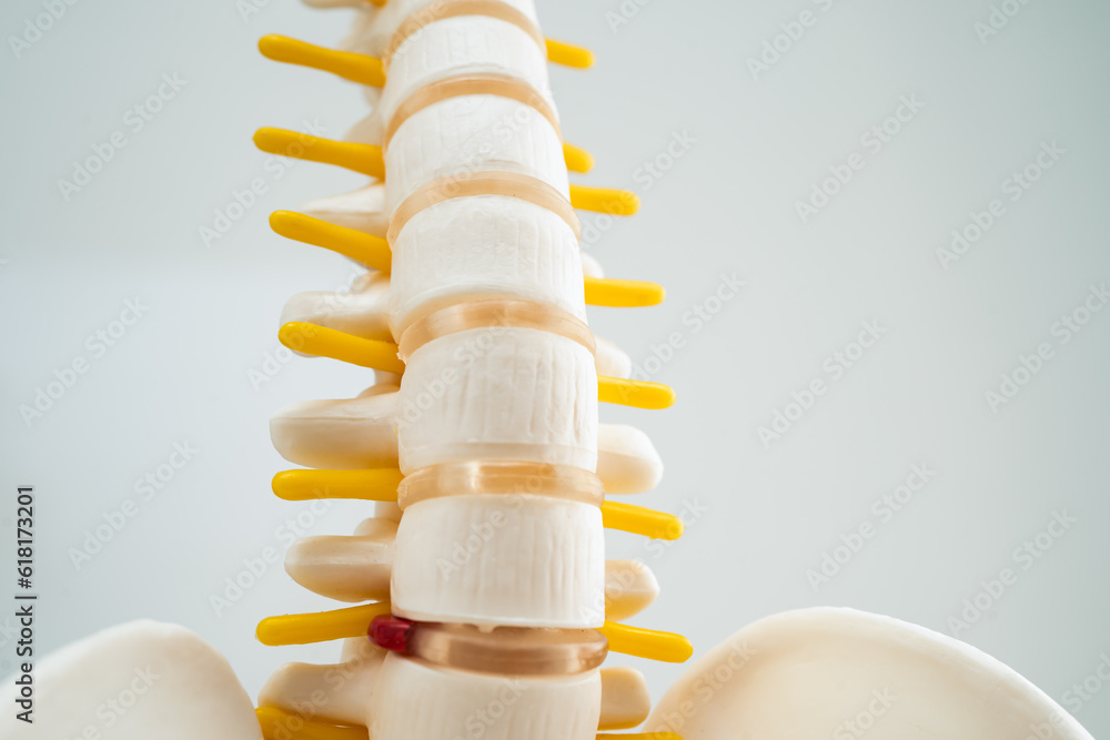 Lumbar spine displaced herniated disc fragment, spinal nerve and bone ...