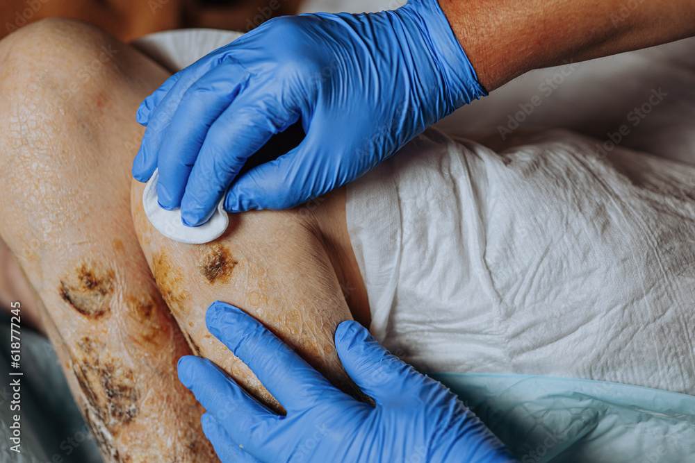 Skin lesions on the leg. Symptoms characteristic of the elderly begin ...