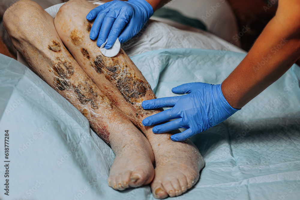 Skin lesions on the leg. Symptoms characteristic of the elderly begin ...