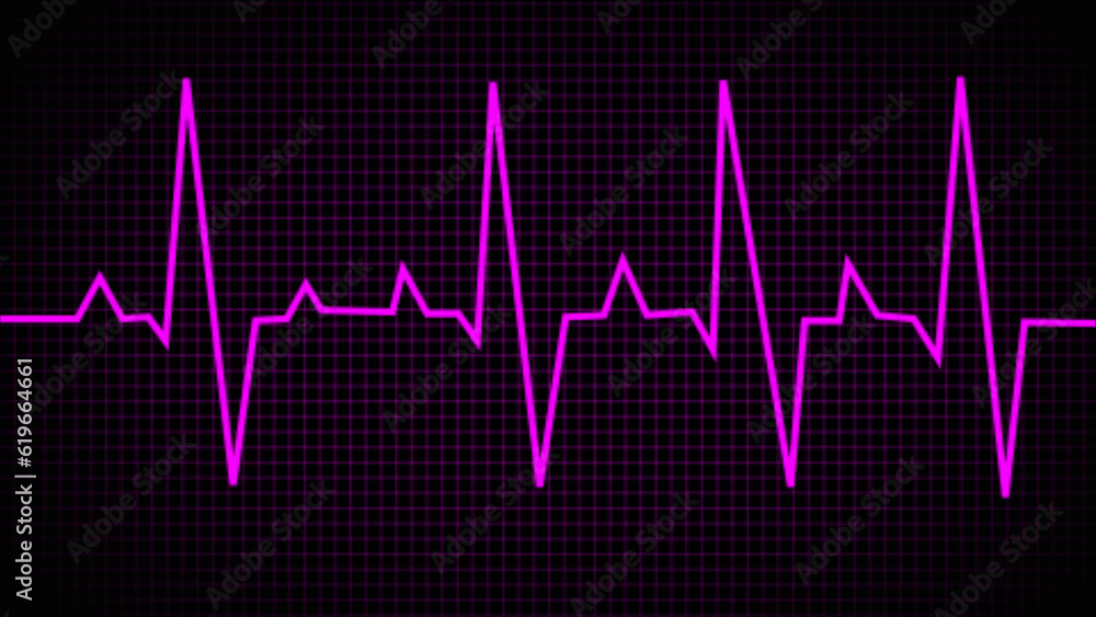 Coronary artery disease. Electrocardiogram show ST elevation myocardial ...