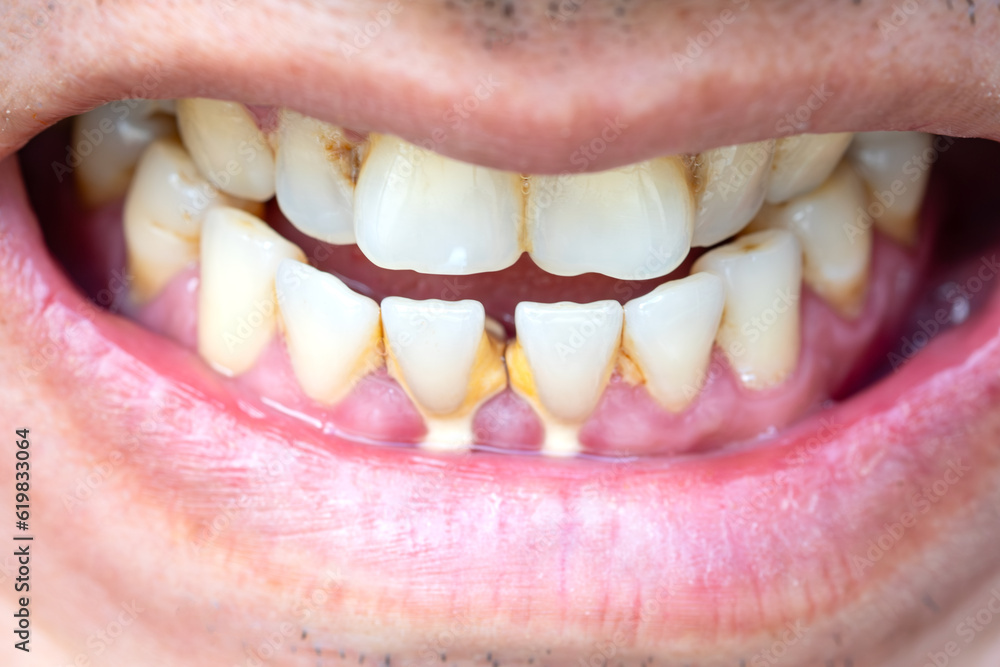 Tooth's a man smoking bad. woman smokes a cigarettes have tooth decay ...