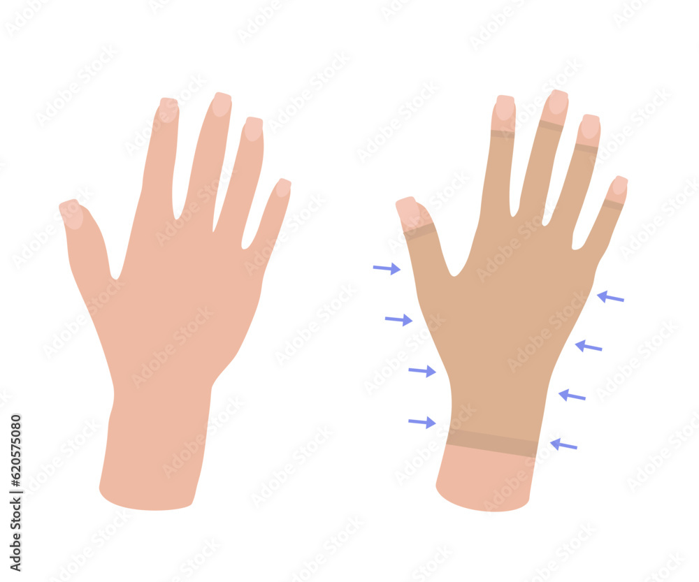 Lymphedema. Female hand in Compression Glove. Woman's hand. Arthritis ...