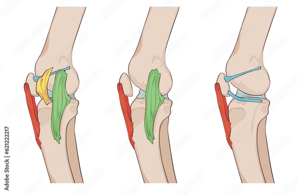 knee ligaments and menisci, with medial patellar retinaculum, medial ...
