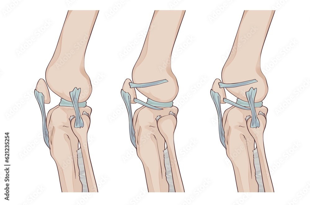 knee ligaments and menisci, with lateral patellofemoral ligament ...