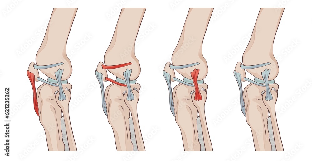 knee ligaments and menisci, with lateral patellofemoral ligament ...