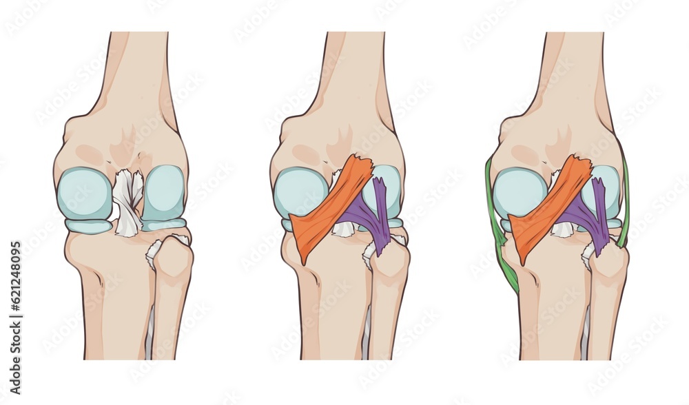 knee ligaments and menisci, with oblique popliteal ligament, medial ...