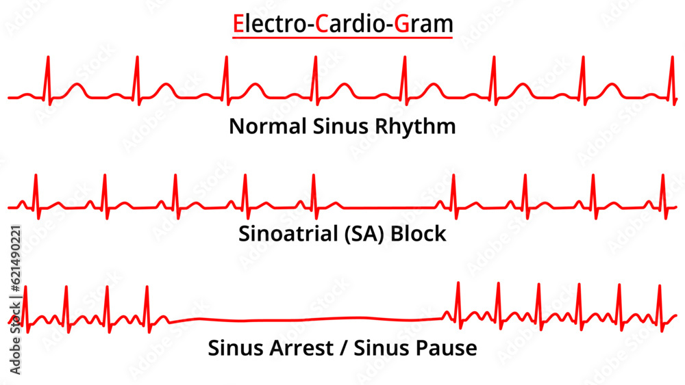 Set of ECG Common Abnormalities - Sinoatrial (SA) Block - Sinus Arrest ...