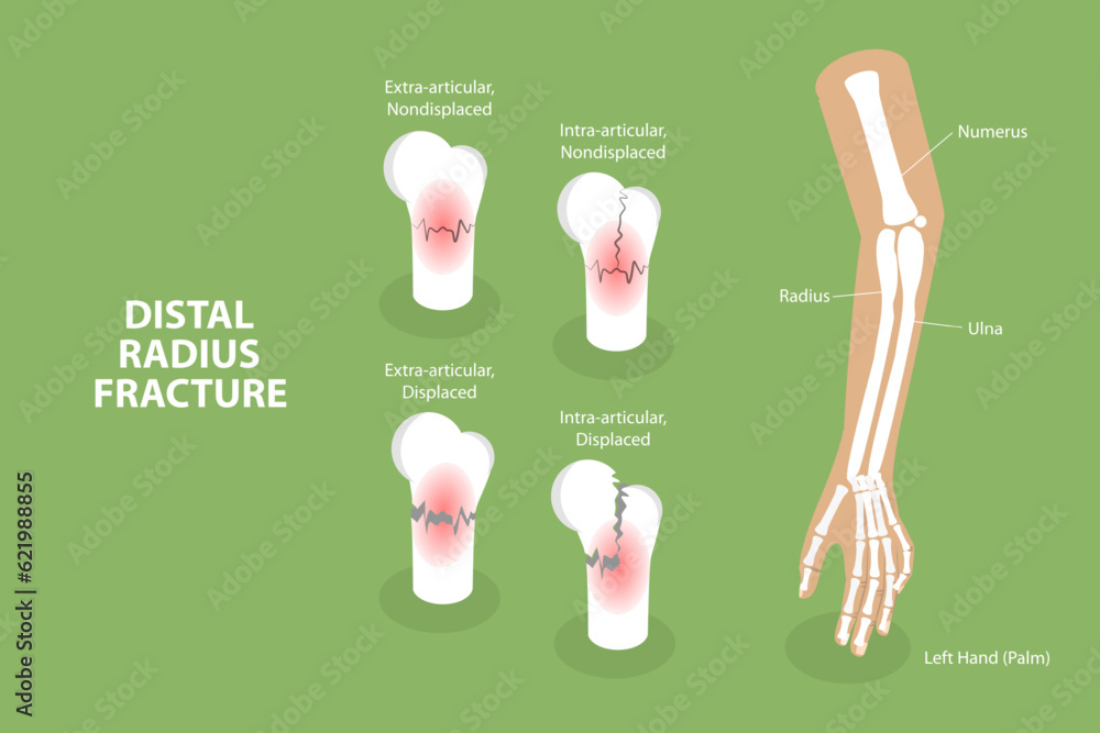 Vector de Stock 3D Isometric Flat Vector Conceptual Illustration of Distal Radius Fracture ...