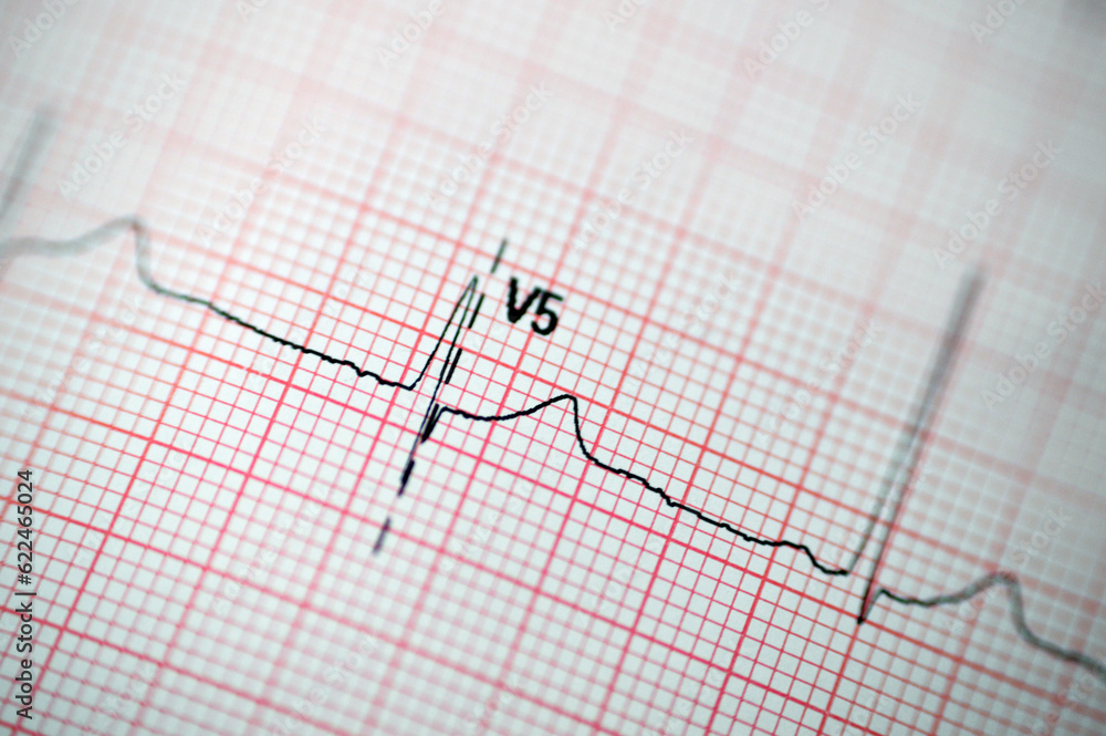 ECG ElectroCardioGraph paper that shows sinus rhythm abnormality of right ventricular ...