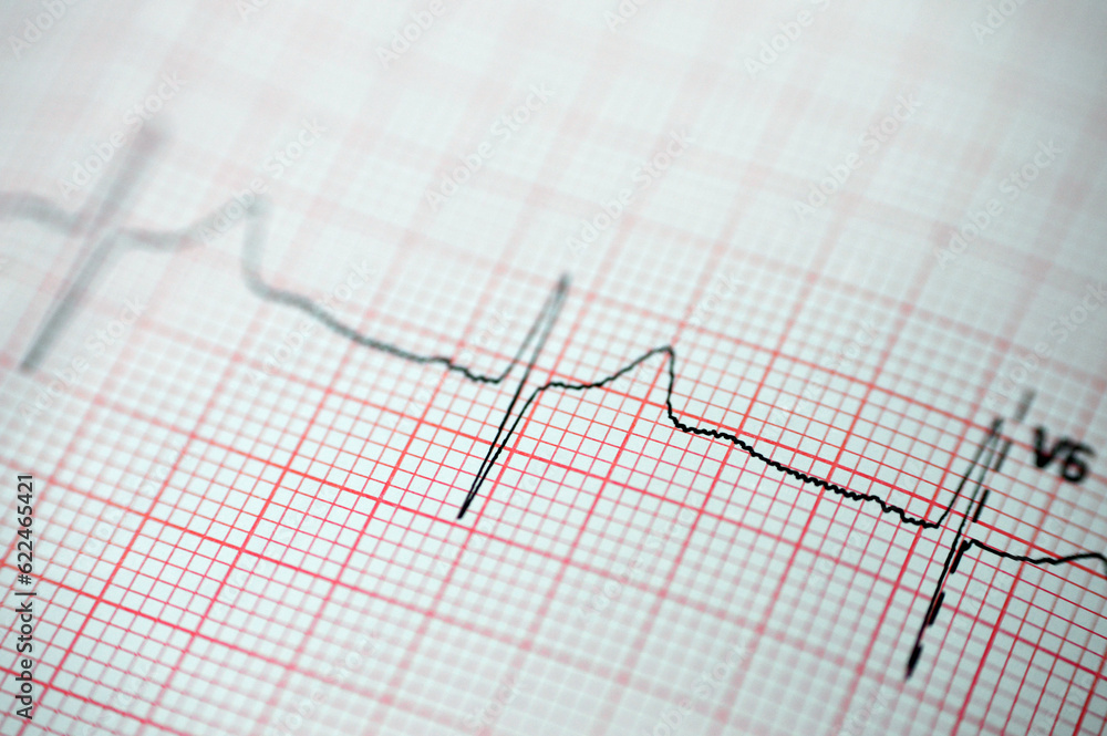 ECG ElectroCardioGraph paper that shows sinus rhythm abnormality of ...