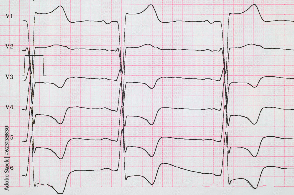 ECG. Myocardial infarction on ECG, subendocardial ischemia in chest ...