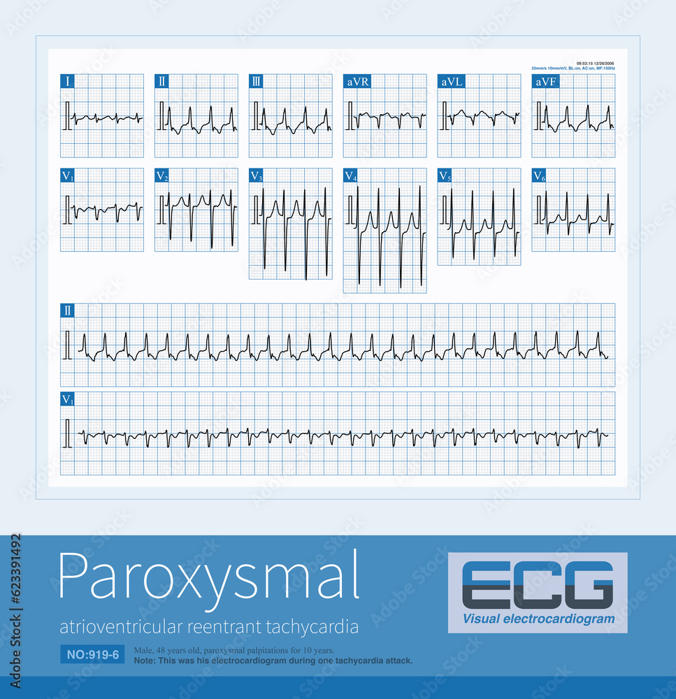 Male, 48 years old, paroxysmal palpitations for 10 years. ECG showed ...