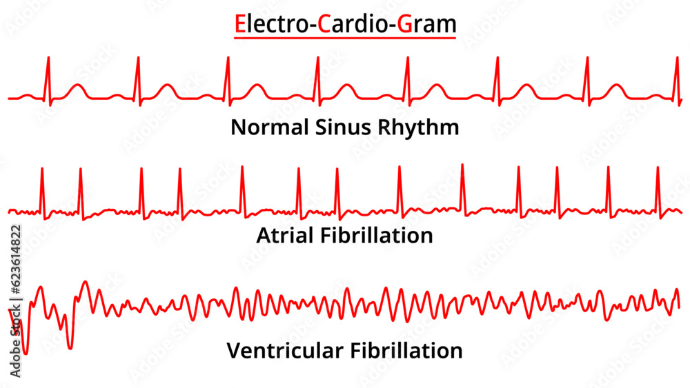 Set of ECG Common Abnormalities - Atrial Fibrillation - Ventricular ...