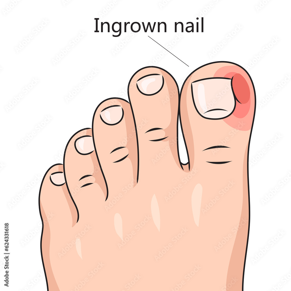Ingrown nail onychocryptosis diagram schematic raster illustration ...