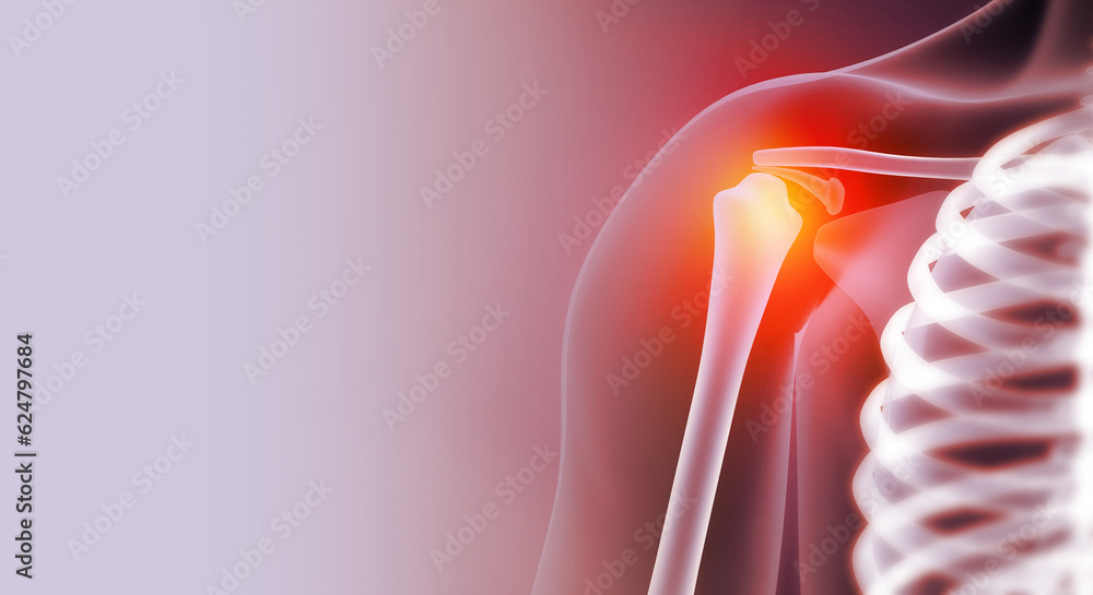 Human shoulder joint pain, x-ray view, shoulder ligament tendinitis ...