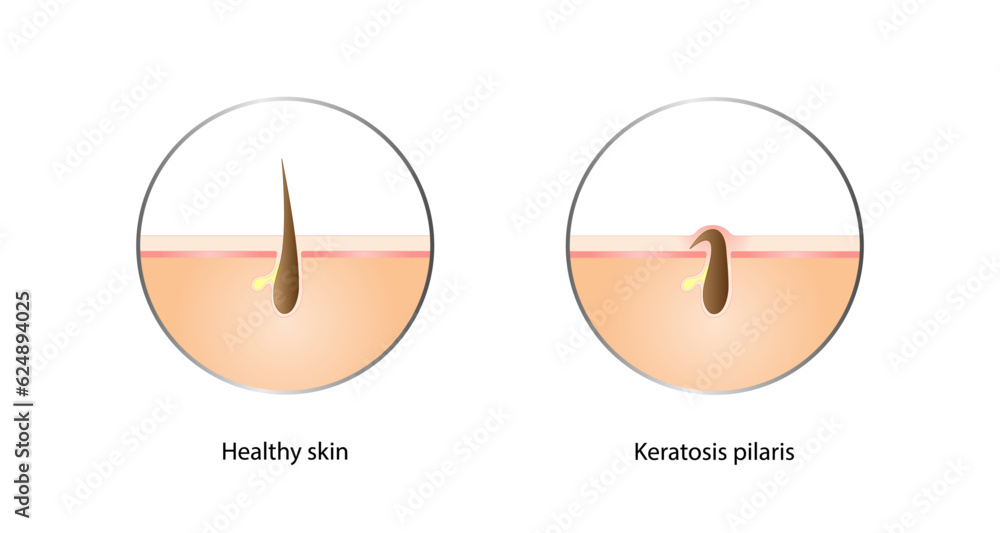 Keratosis pilaris, Ingrown hair, Chicken skin, Keratin plug and Bumpy ...