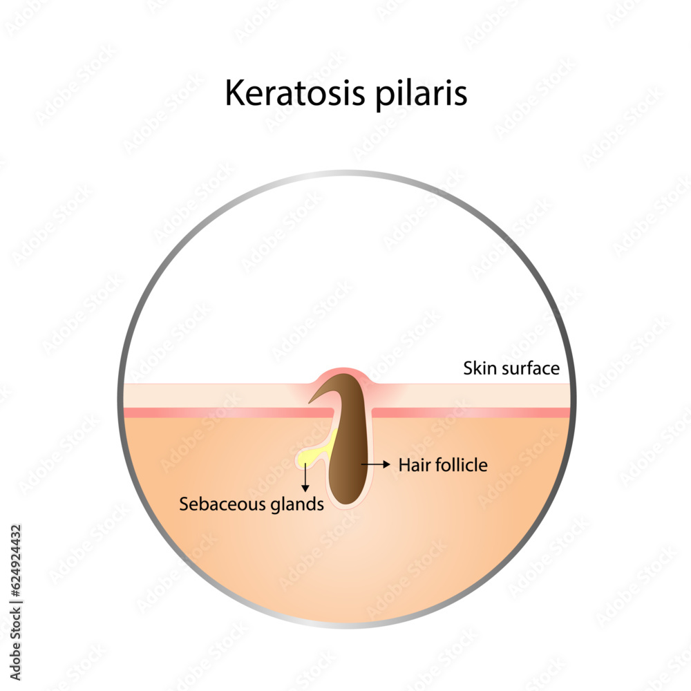 Keratosis pilaris, Ingrown hair, Chicken skin, Keratin plug and Bumpy ...