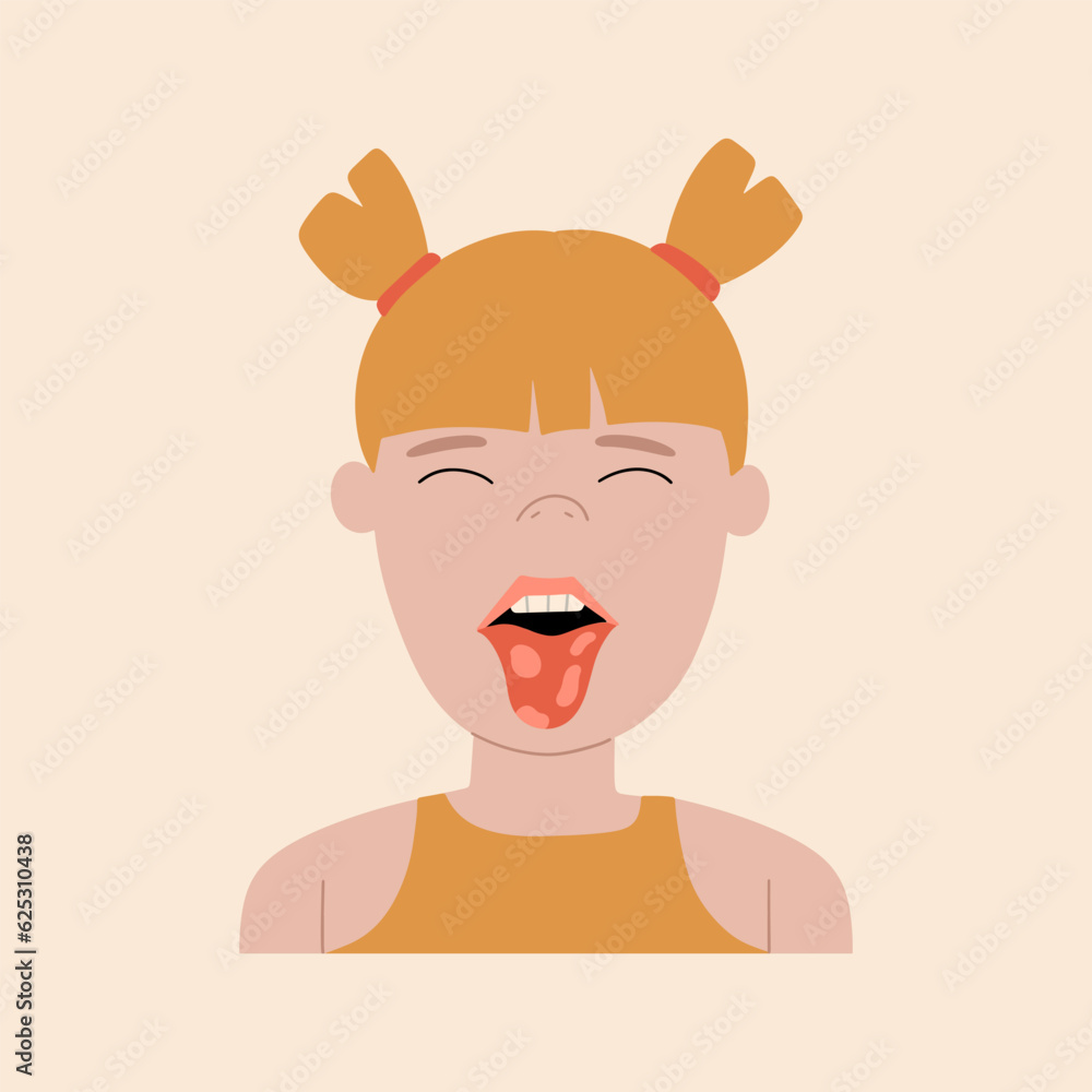 The girl shows the geographical tongue. Symptom of stomatitis ...