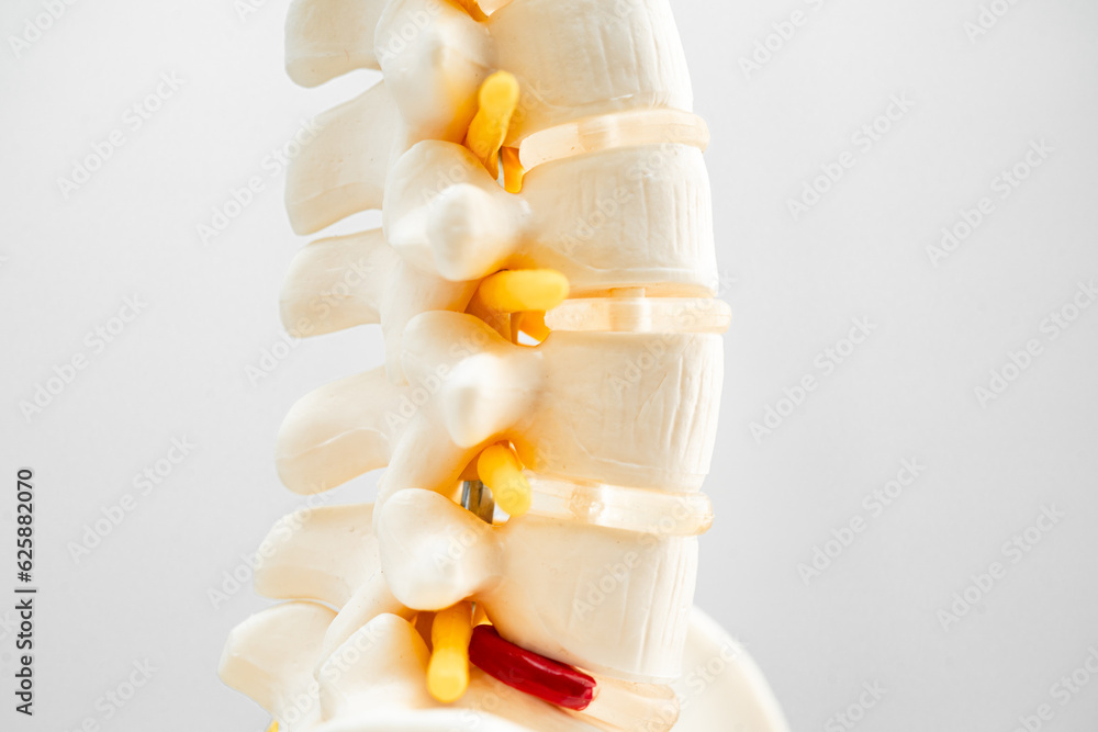Lumbar spine displaced herniated disc fragment, spinal nerve and bone ...