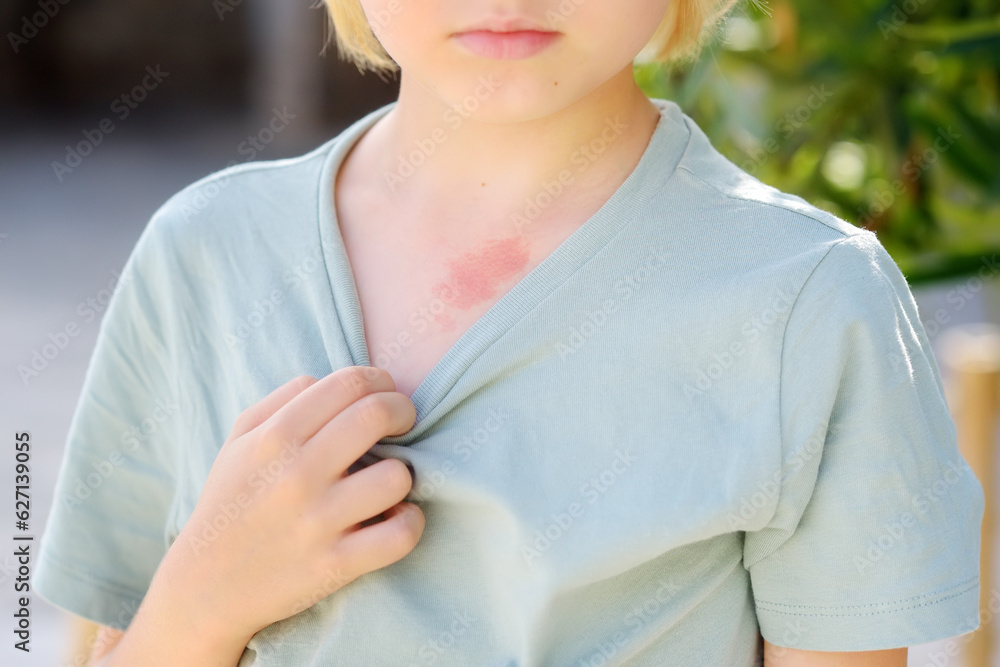 Mark on the skin of chest of eight years old child. Hemangioma is a red ...