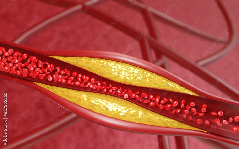 Hyperlipidemia. Blocked artery concept and human blood vessel as a ...