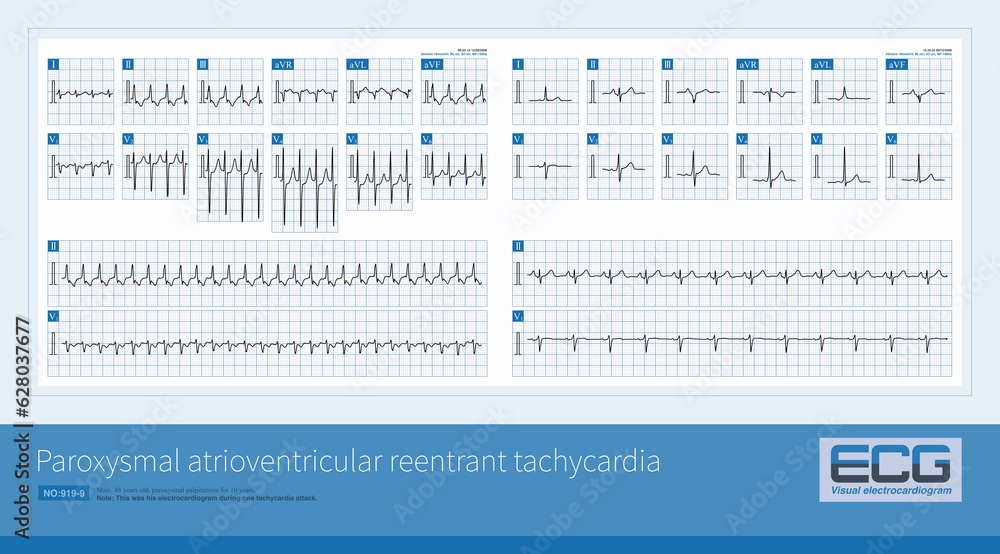 Male, 48 years old, paroxysmal palpitations for 10 years. ECG showed ...