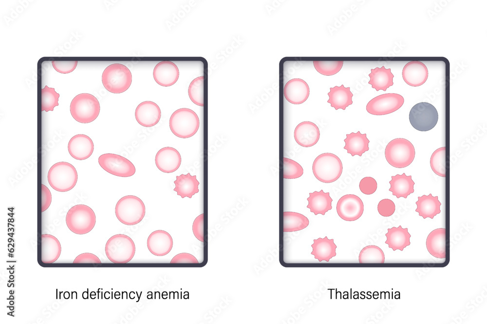 The difference of Iron deficiency anemia and Thalassemia in light ...