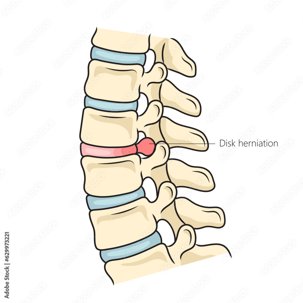 Spinal disc herniation diagram schematic vector illustration. Medical ...