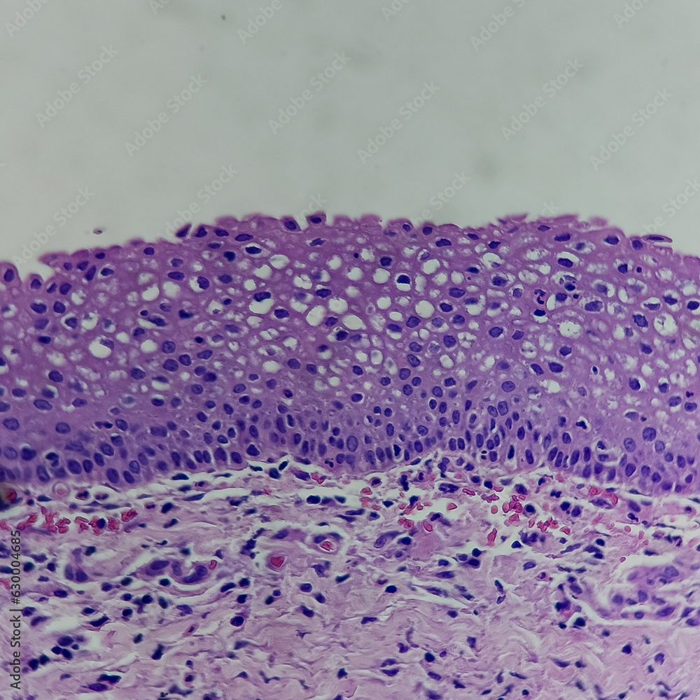 Camera photo of ectocervix, showing koilocytes and low-grade squamous ...